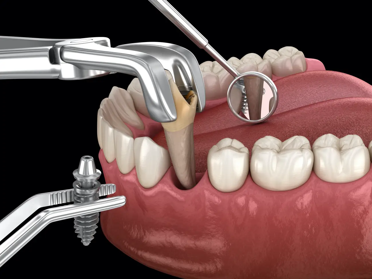 Imedijatna implantacija | Dentus perfectus ordinacija - Najbrža tehnika ...